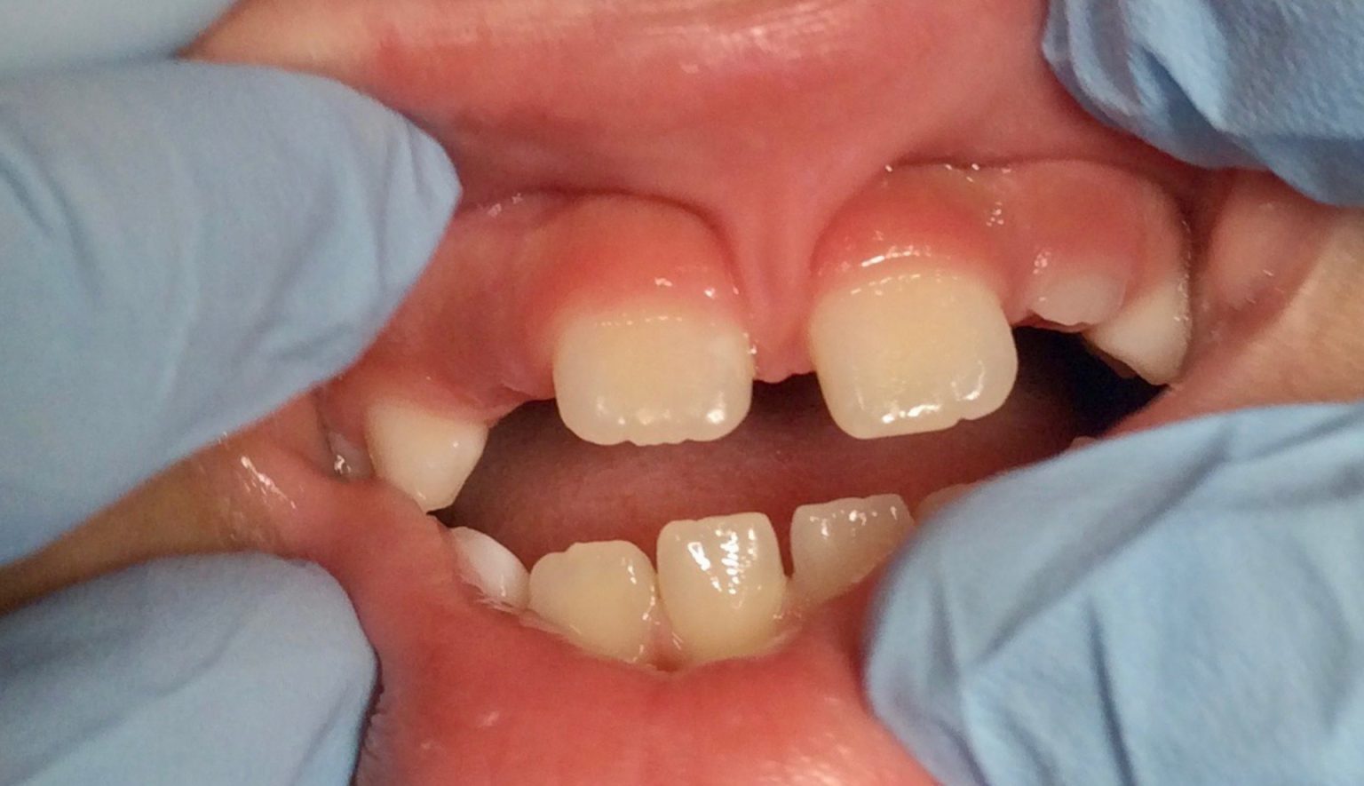 Signs Your Child May Have a Lip or Tongue Tie—and How We Treat It ...