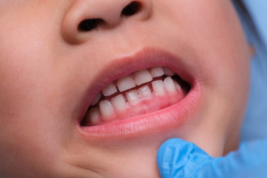 Healthy Jaw Development in Children: A Parent's Guide - Children's ...